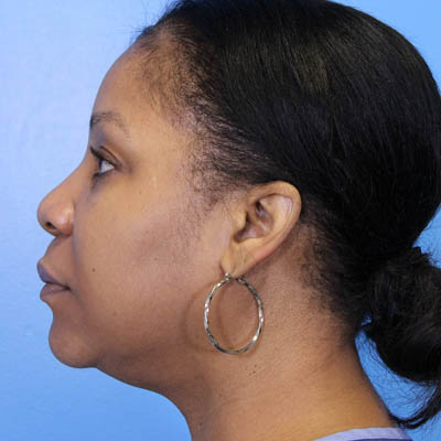 chin4 ava md results | Ava MD