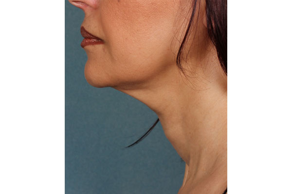 double chin after 3 | Ava MD